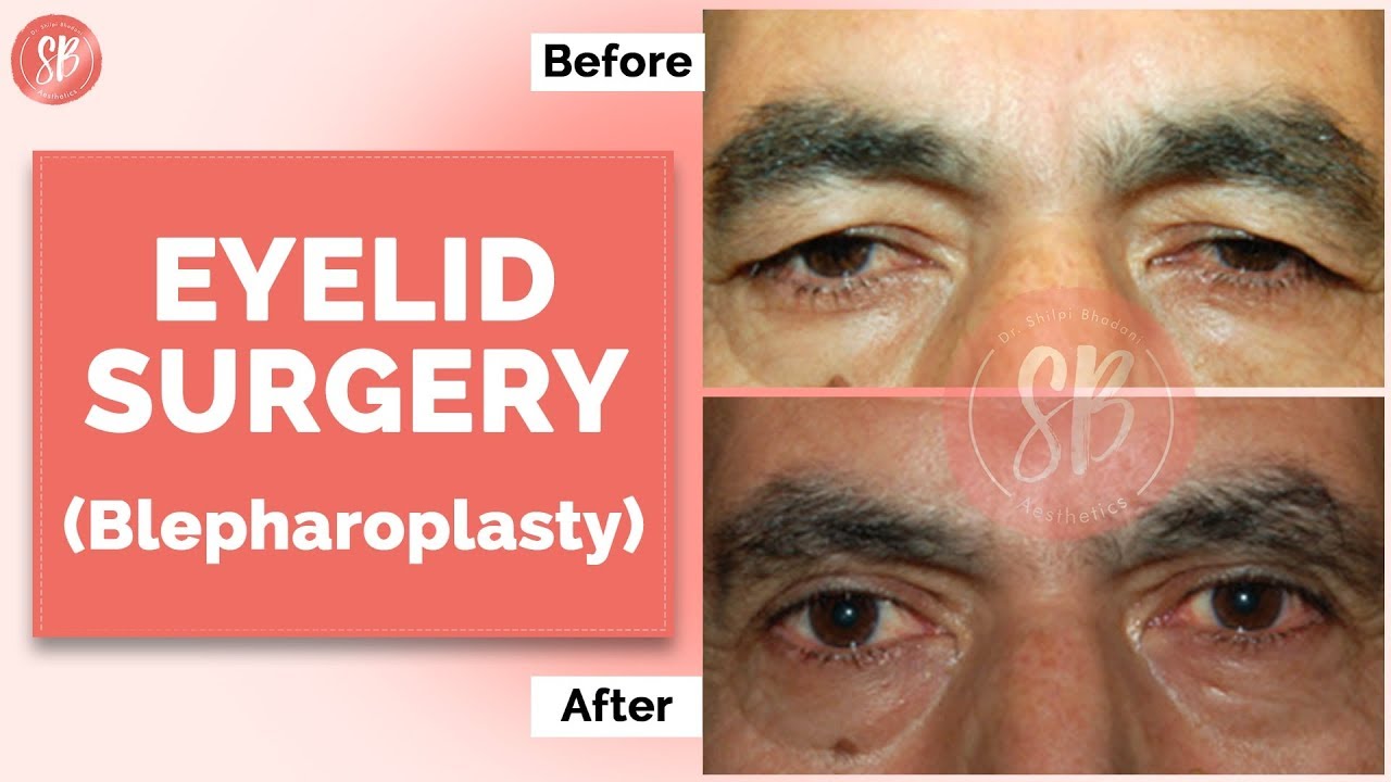 Eyelid Surgery (Blepharoplasty): Everything you need to know! - YouTube