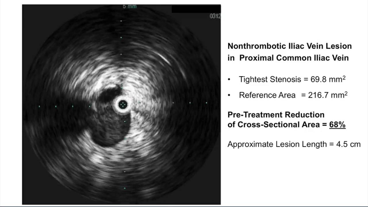 IVUS-Guided Deep Venous Stenting - YouTube