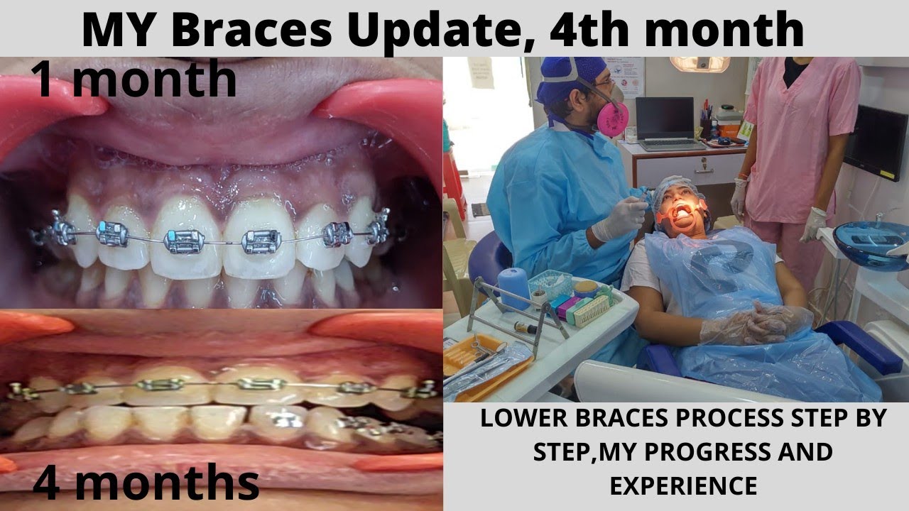 4 months Braces Update | Got my lower braces | Braces process step by ...