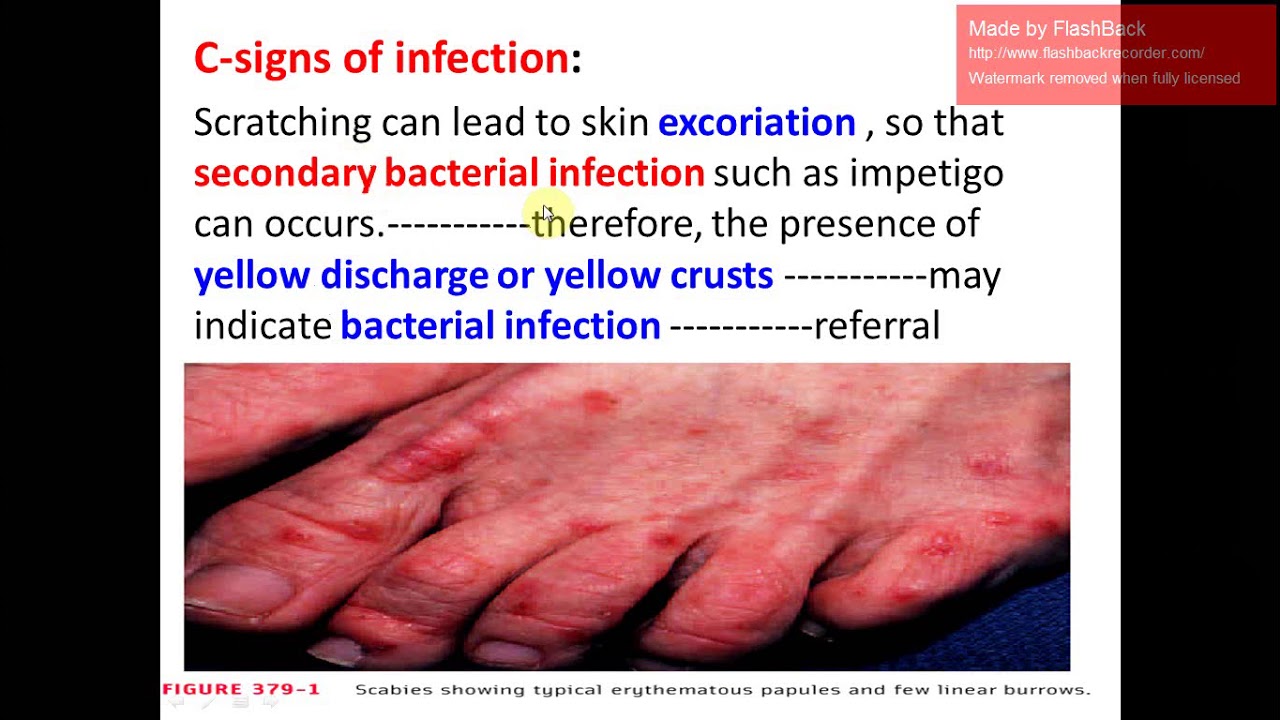 Scabies and Ear Problems. By Dr. Dheyaa Jabbar - YouTube