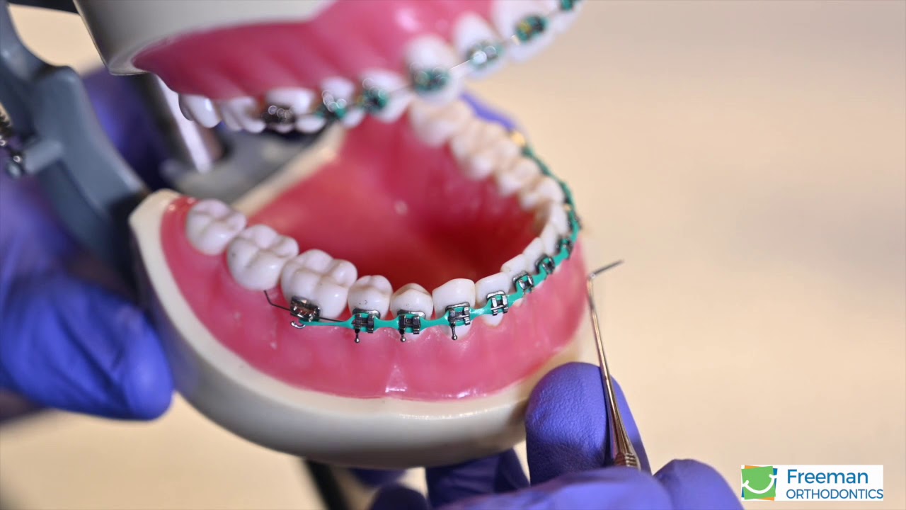 Correct a Rotated Wire -- Freeman Orthodontics Sarasota, FL - YouTube