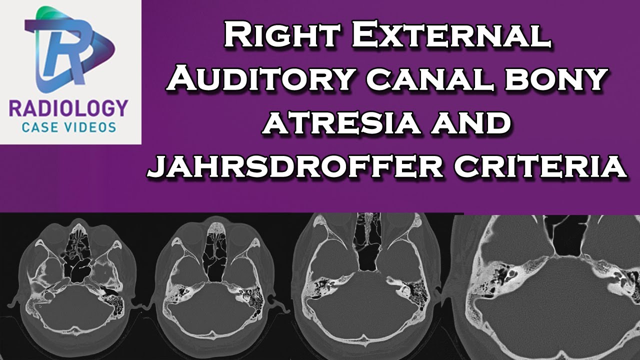 Right External Auditory canal bony atresia and jahrsdroffer criteria ...