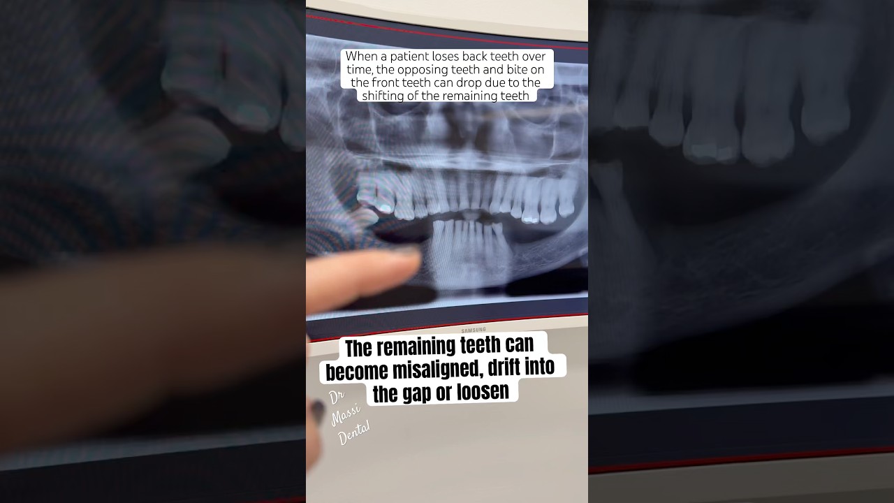 Consequences of Missing Teeth - YouTube