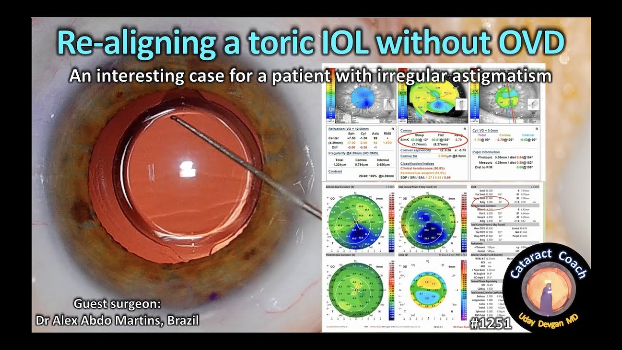 CataractCoach 1251: re-aligning a toric IOL without OVD - YouTube