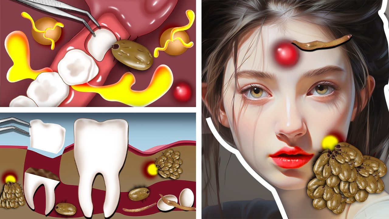 ASMR Removes dog ticks, tooth decay larvae and maggots on the face ...