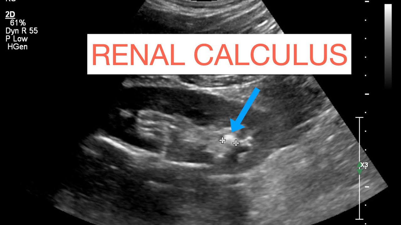 Renal calculus with typical shadowing - YouTube