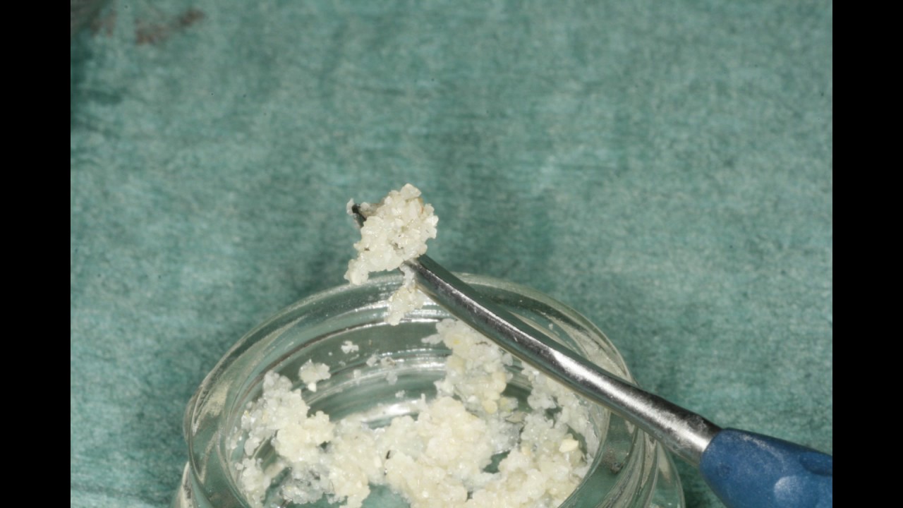 Ridge Preservation with the Smart Dentin Grinder and Gelastypt by Dr ...