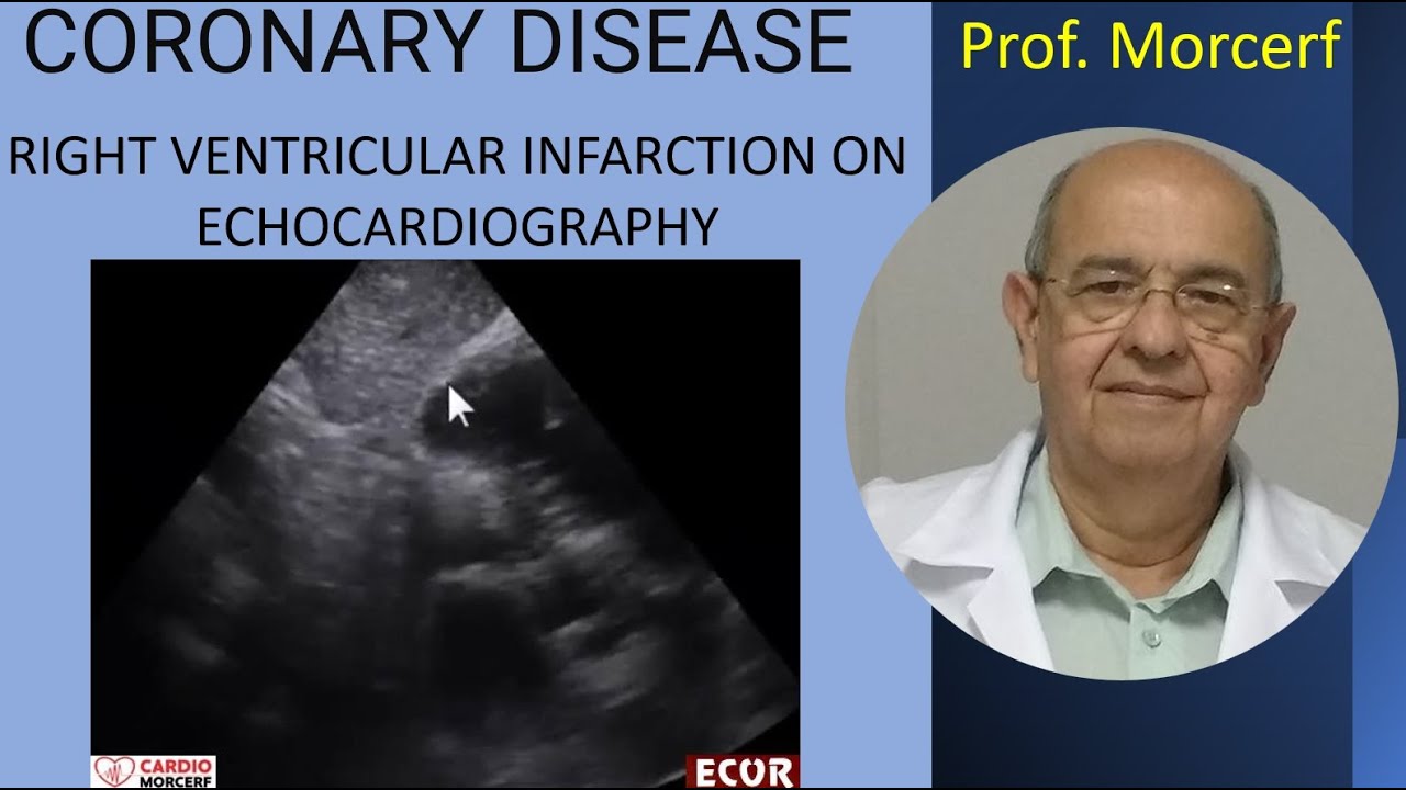 RIGHT VENTRICULAR INFARCTION ECHOCARDIOGRAM - YouTube