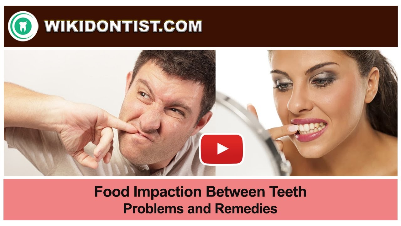 Food Impaction Between Teeth l Problems and Remedies - YouTube