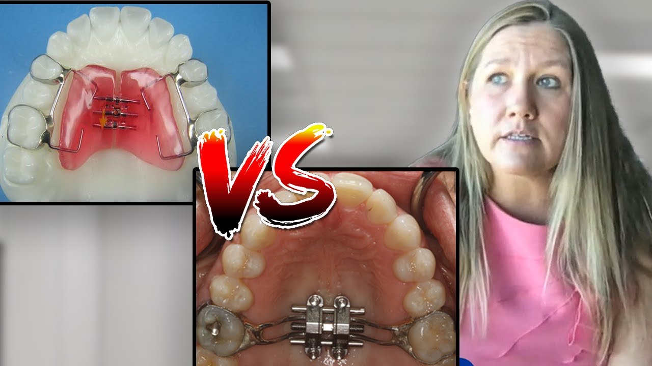 Tooth Borne vs Bone Borne Expanders in Children - YouTube