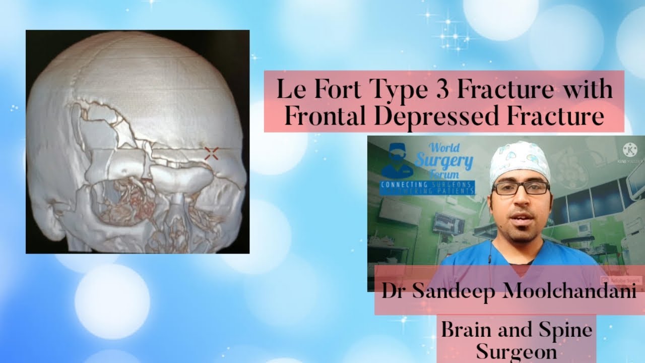 Le Fort Type 3 Skull Fracture & Frontal Depressed Fracture | Dr Sandeep ...
