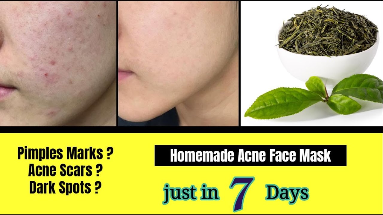 DIY Pimples pack for Clear skin / How to Get Rid Of Acne scars ...