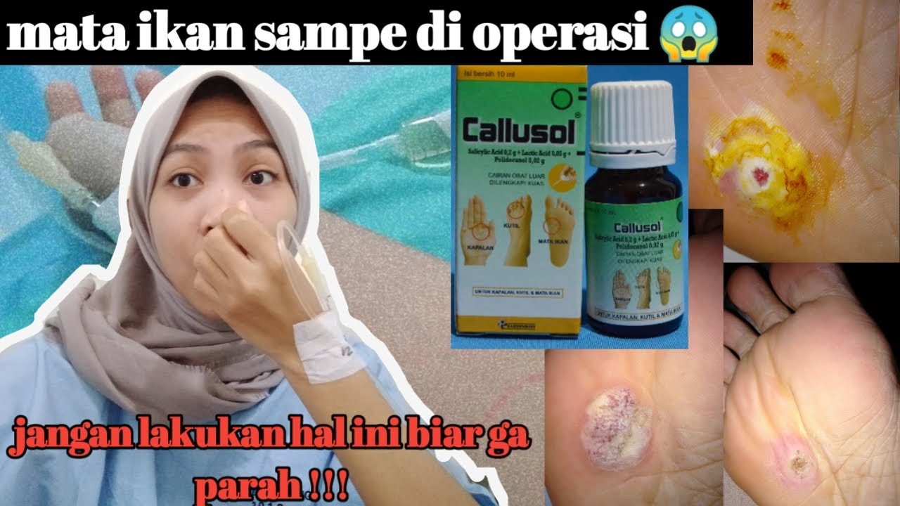 CARA MENGHILANGKAN MATA IKAN !! Awas jangan lakukan Hal ini agar tidak di Operasi ! - YouTube