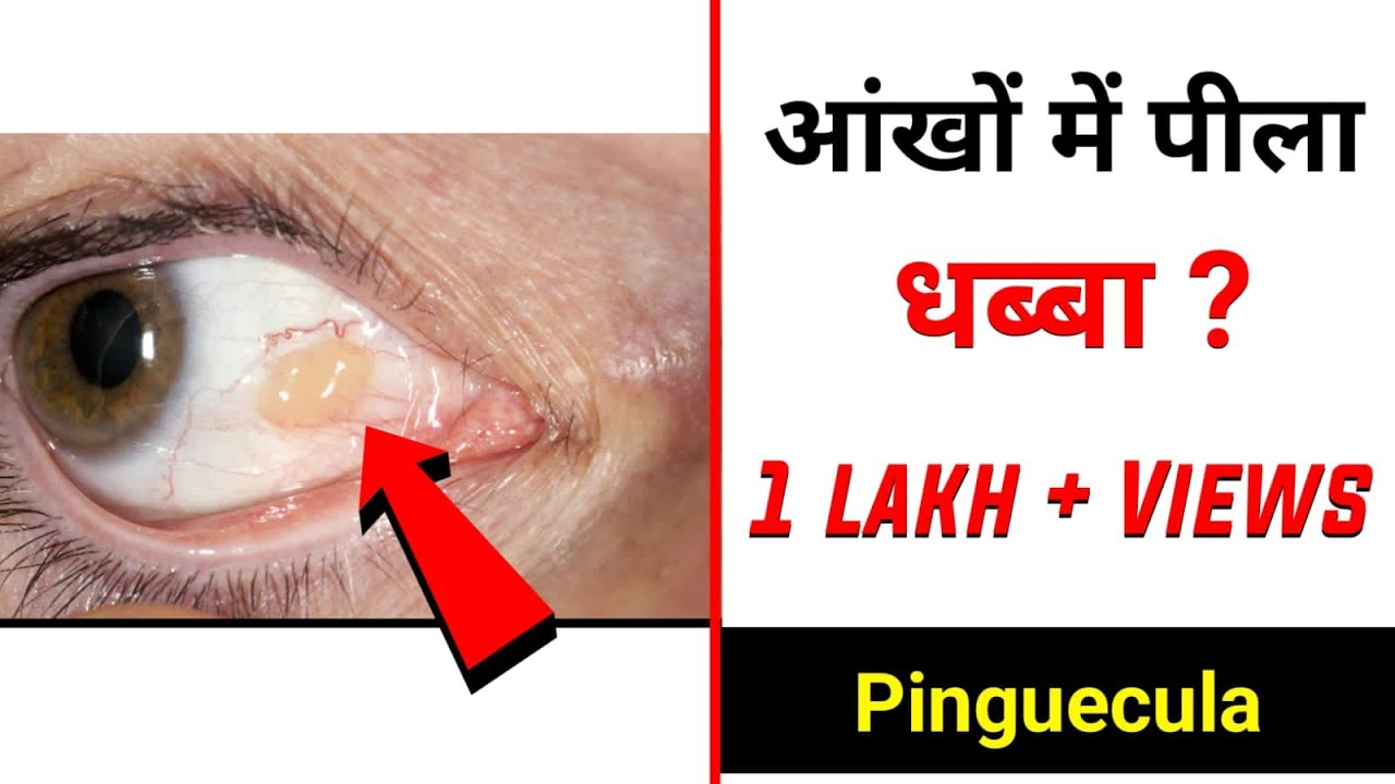 Pinguecula Causes Symptoms and Prevention| Yellow bump on eye's| in ...