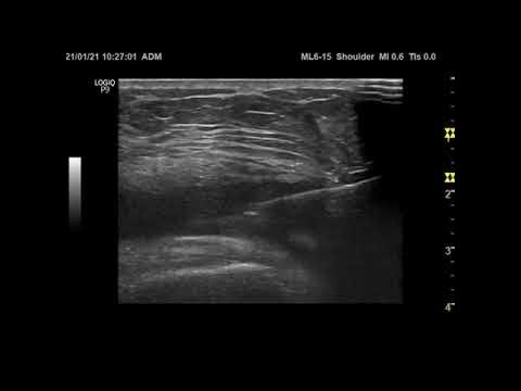 Ultrasound guided intraarticular knee-injection. - YouTube