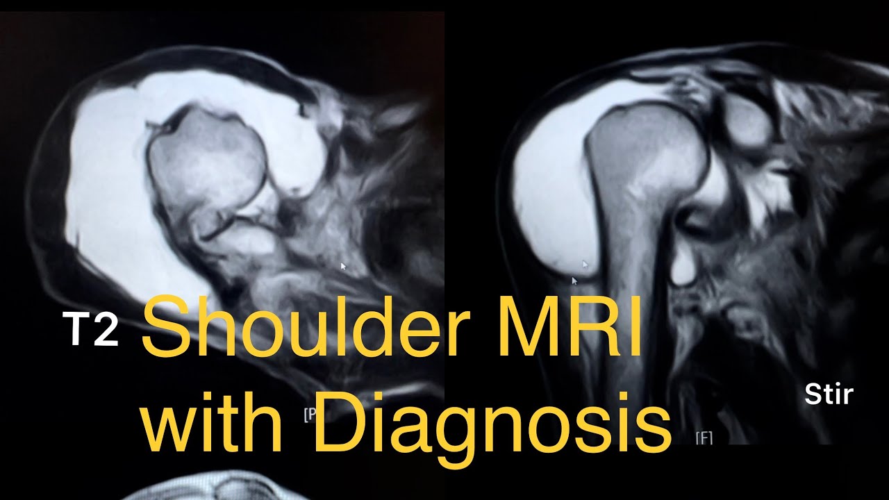 MRI Case 52 ,Shoulder joint Osteomyelitis with Abscess ...