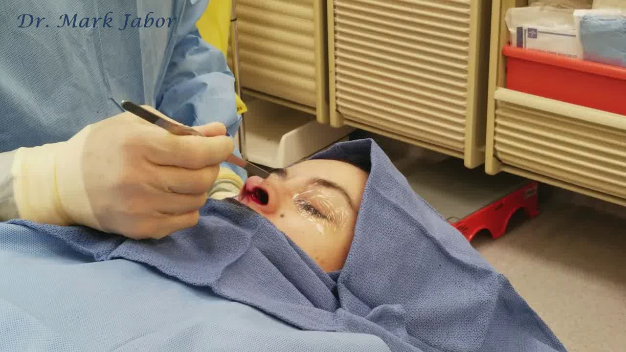 Rhinoplasty with Dr. Mark Jabor at El Paso Plastic Surgery - YouTube