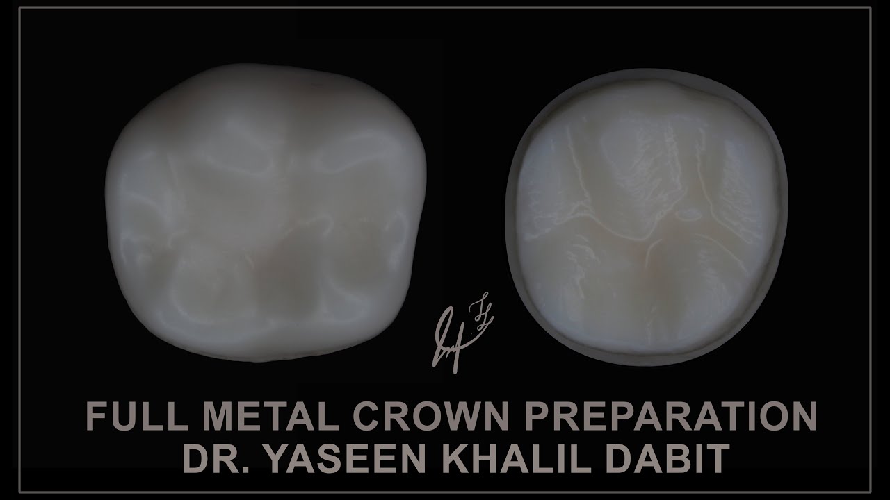 Full metal crown preparation (lower 6) - YouTube