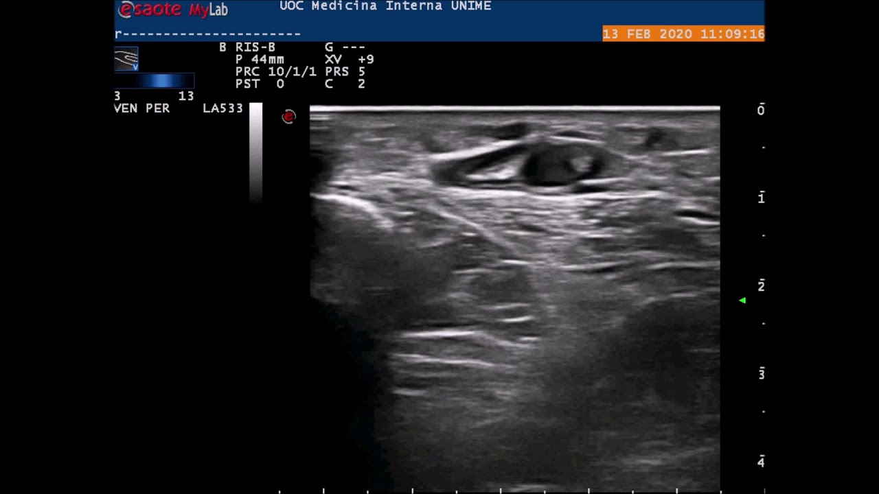 ULTRASOUND Phlebitis, superficial venous thrombosis Varicose vein - YouTube