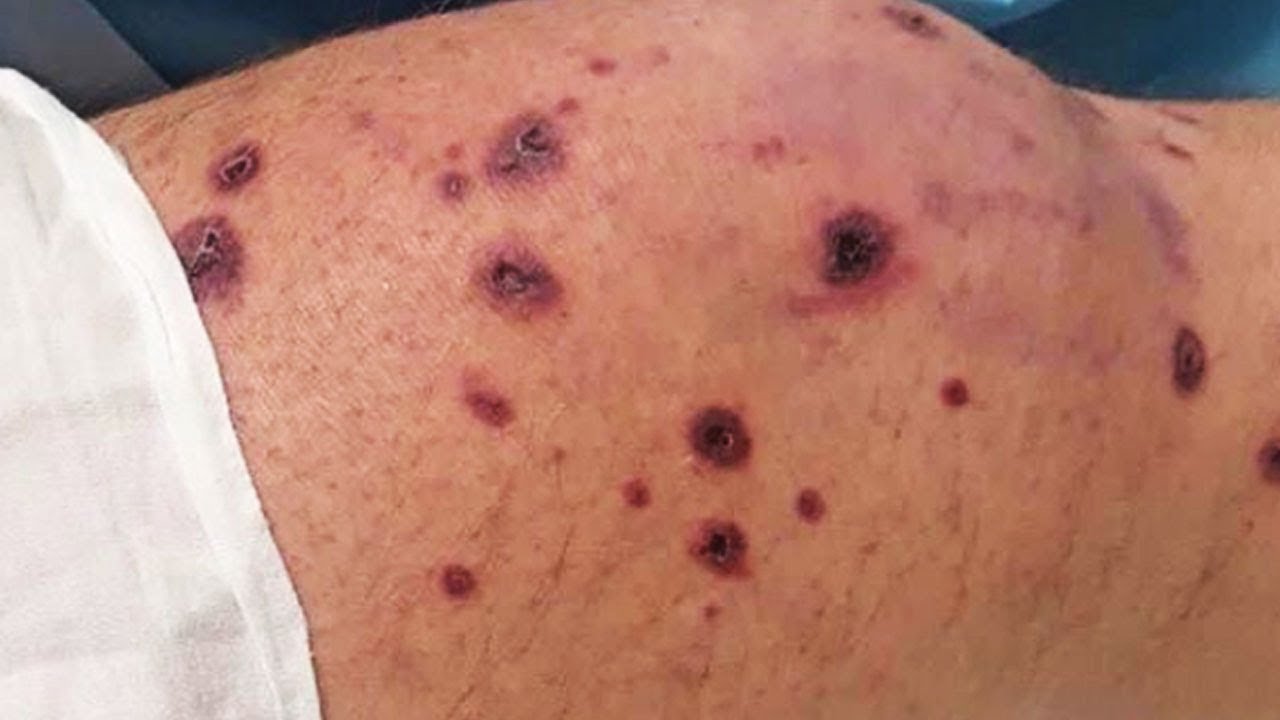 Septic Blackheads? Real or Fake, Cysts & Comedones - YouTube