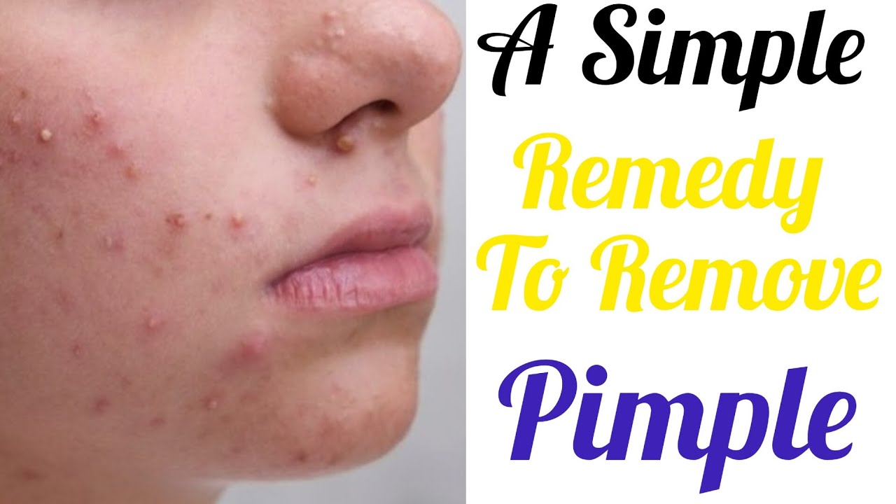 A Simple Remedy To Remove Pimple - YouTube