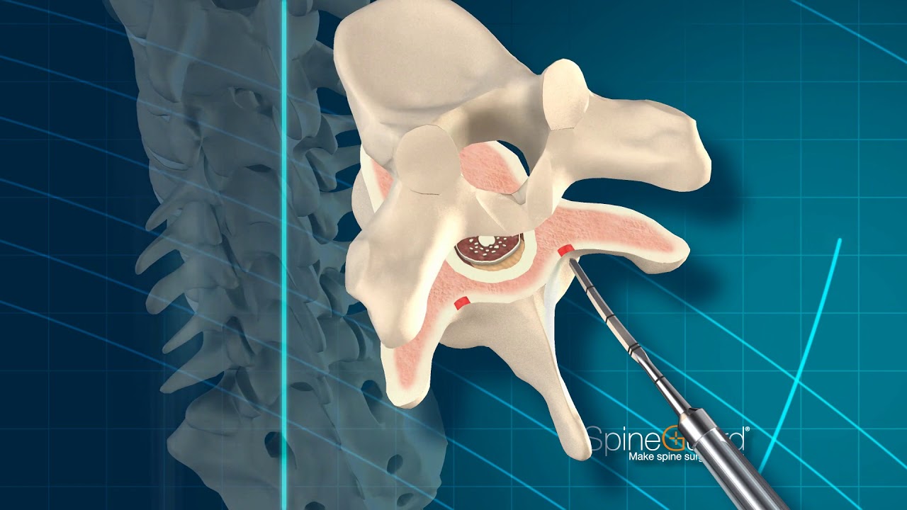 Curved PediGuard Animation - YouTube