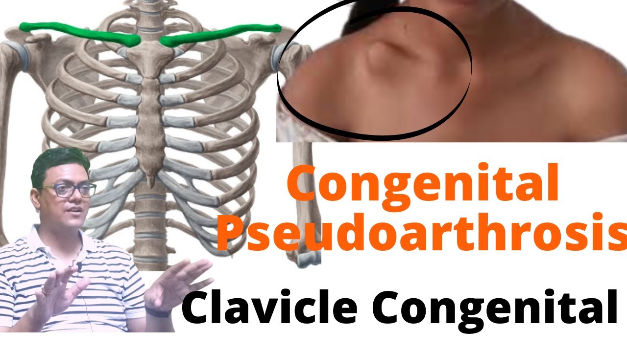 Congenital Pseudoarthrosis of Clavicle | Congenital Deformity - YouTube