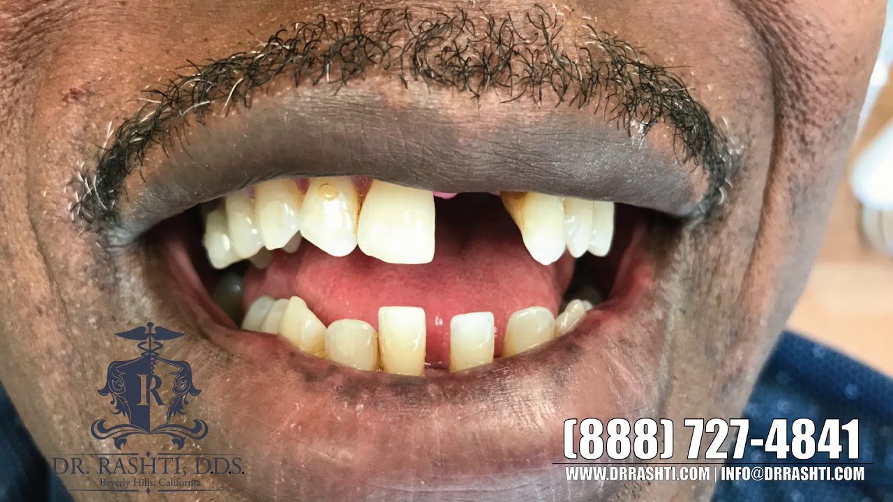 Dental Implant Before and After | Dr. Mahnaz Rashti, D.D.S. | Beverly ...