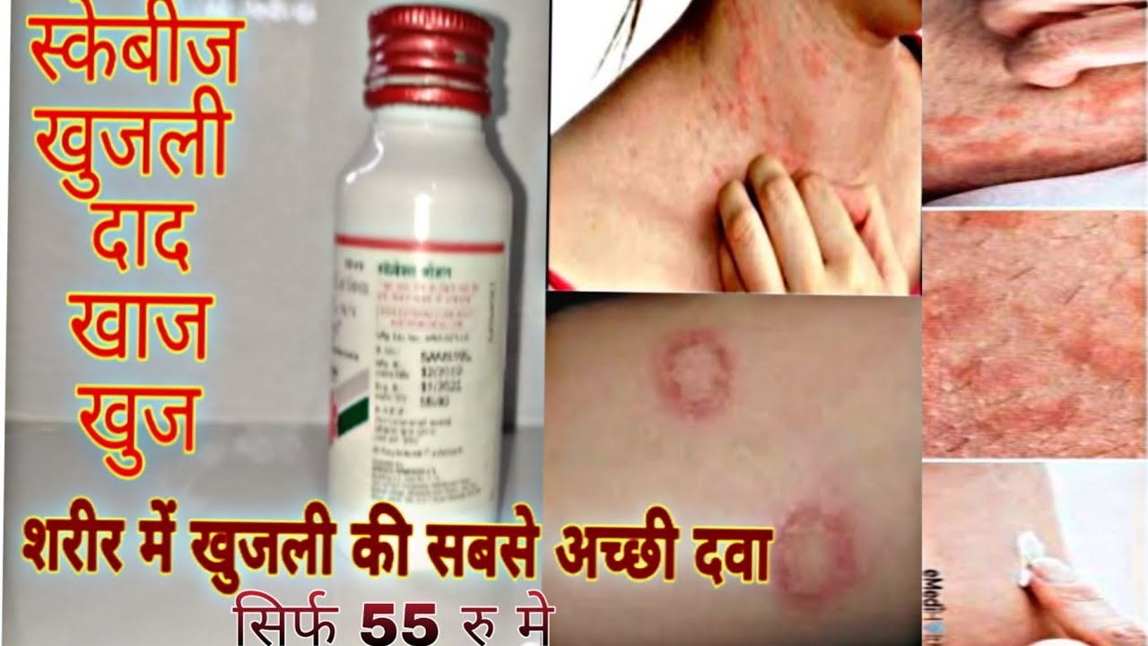 Scabex lotion Fungal infectionको करें जड़ से खत्म | treatment fungal ...