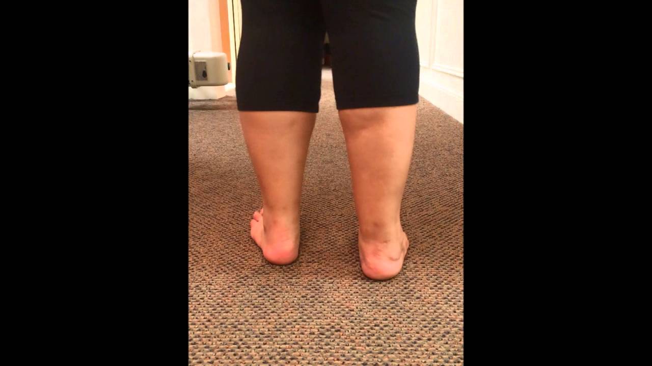 Gait Status Post Subtalar Fusion and Calcaneal Osteotomy Surgery SFISM ...