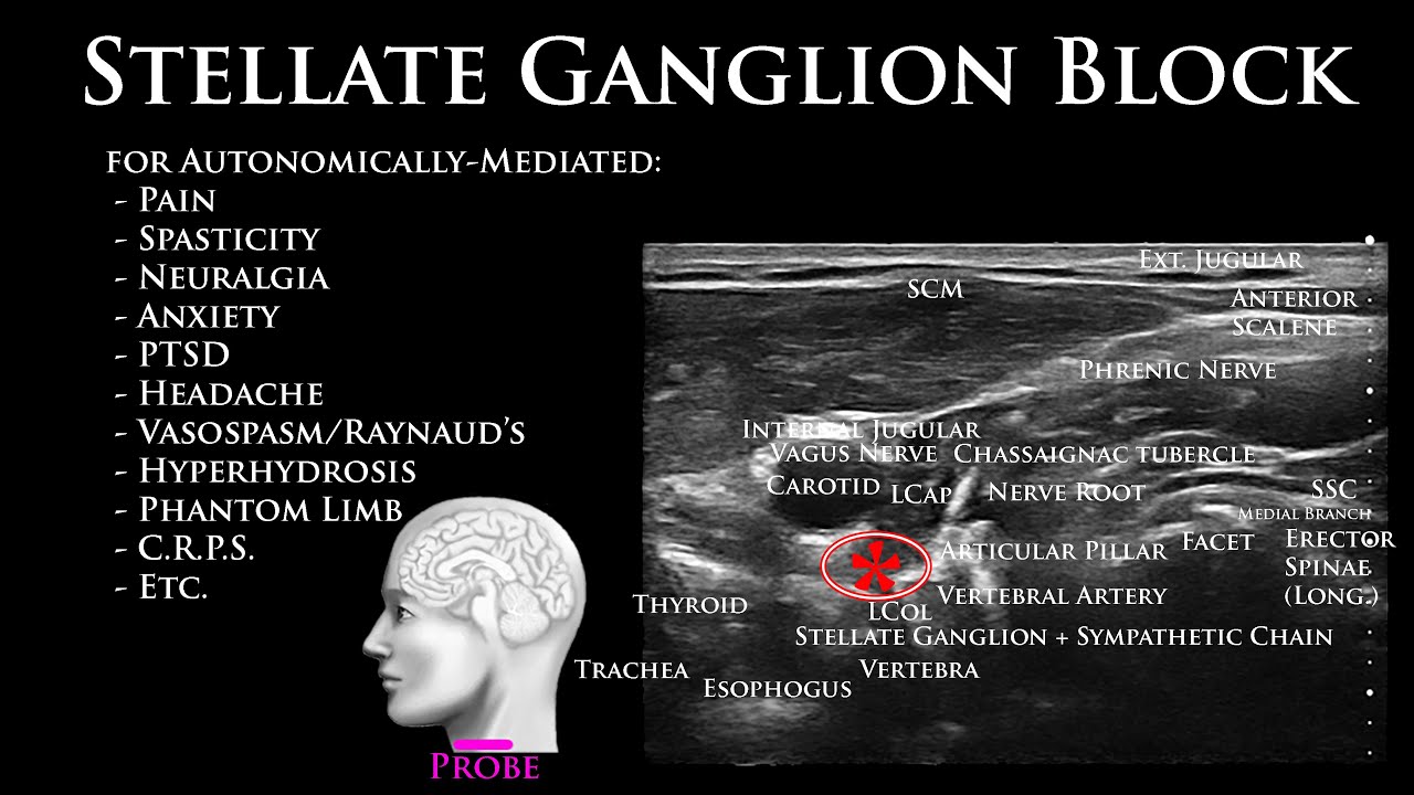 Stellate Ganglion Block - How and Why - Ultrasound-Guided Technique and ...