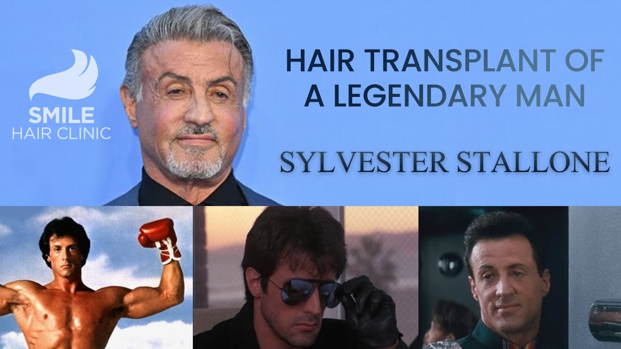 HAIR TRANSPLANT OF A LEGENDARY MAN / SYLVESTER STALLONE | SMILE HAIR ...