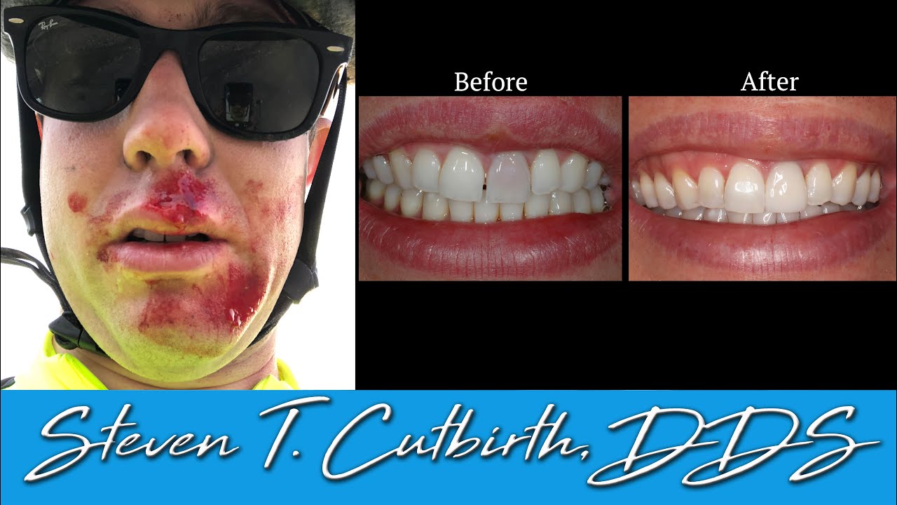 Bike Wreck - Tooth Meets Pavement! - Dental Minute with Steven T ...