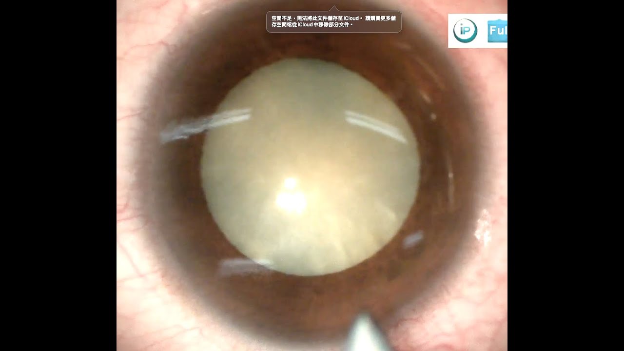 Complicated cataract surgery: Phacoemulsification white cataract ...