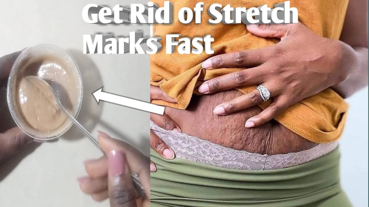 How to Remove Stretch Marks Permanently: World Best Remedy to Get Rid ...