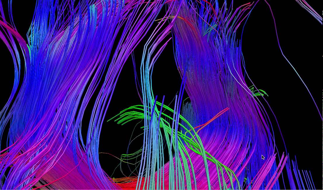 Diffusion Tensor Tractography DTI MRI 5 - William Edward Hahn - YouTube