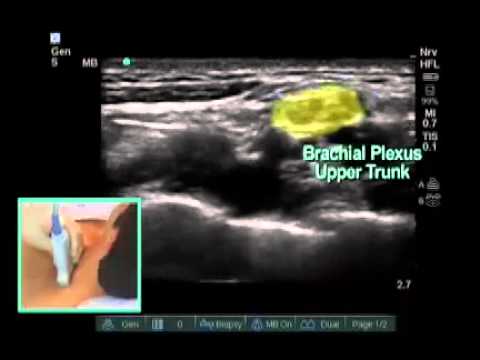 How to: Ultrasound Guided Interscalene Brachial Plexus Nerve Block ...