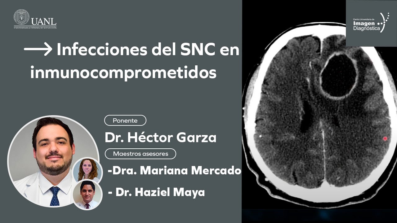 Infecciones del SNC en inmunocomprometidos por el Dr. Héctor Garza ...
