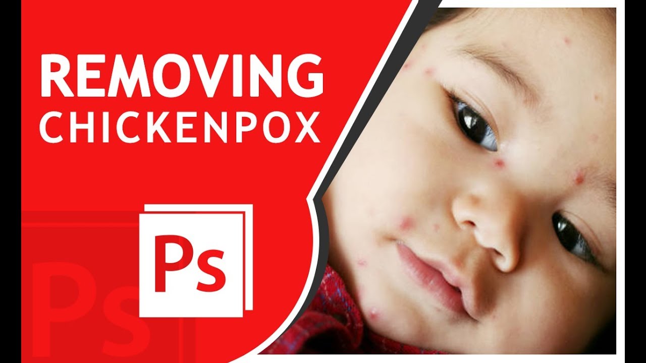 How to remove chicken pox in photoshop - YouTube