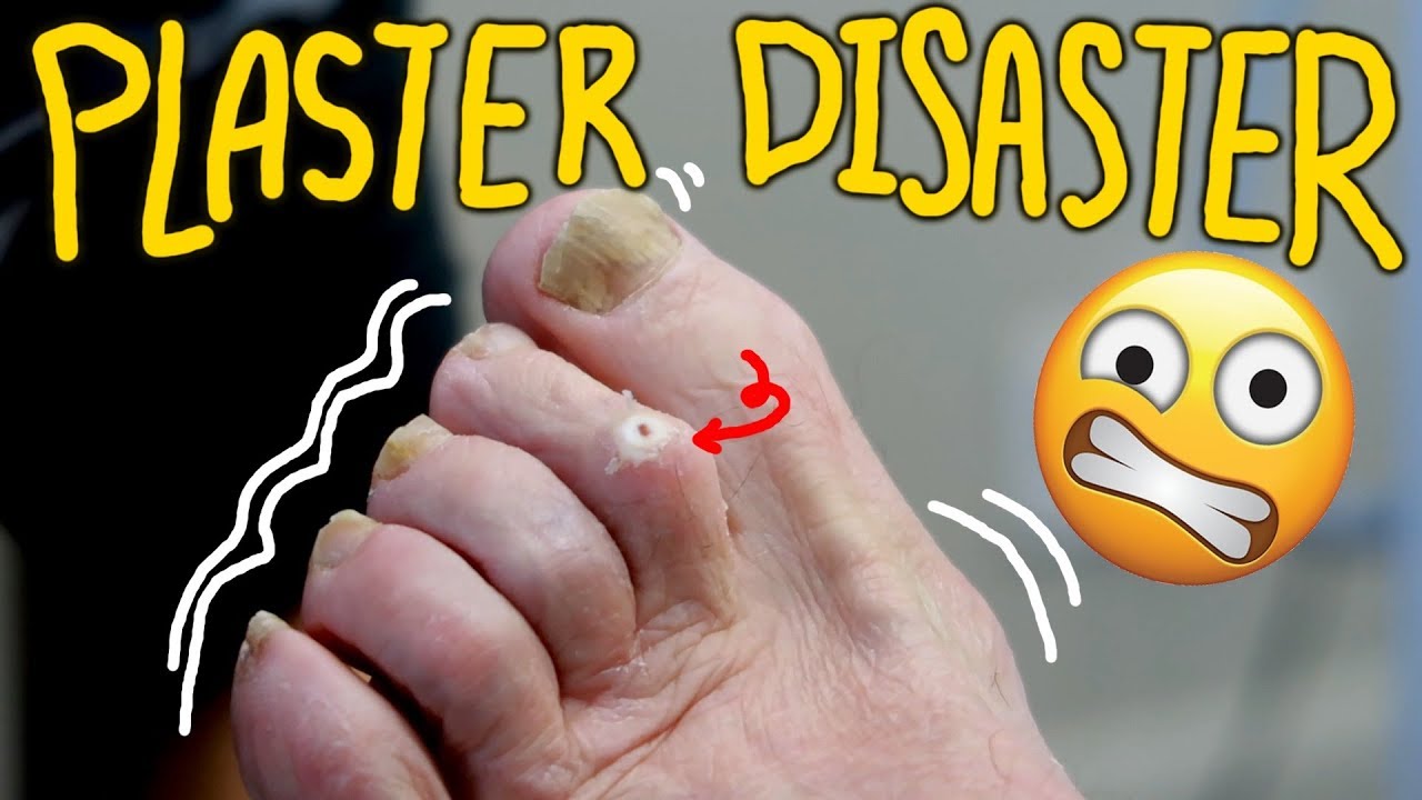 DISASTROUS Corn Plaster and Callus Removal *Don't WASTE Your Time ...