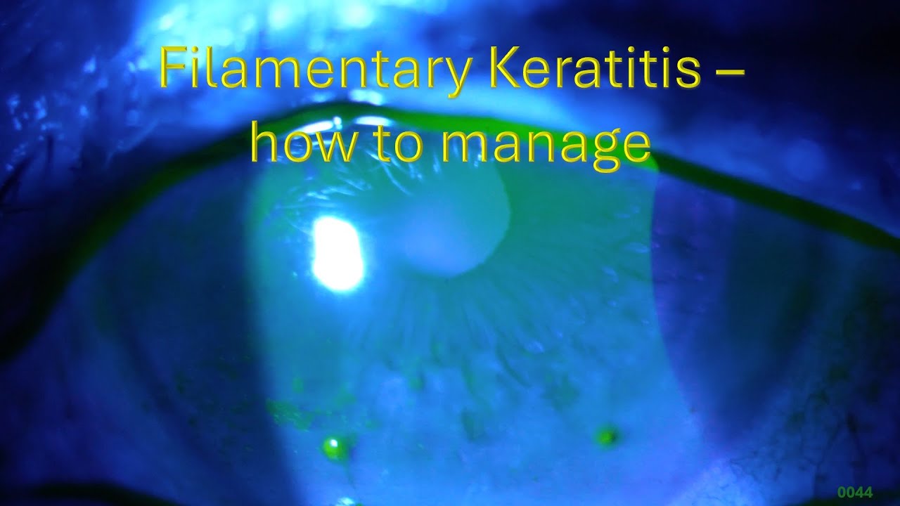 0044: Filamentary Keratitis - how to manage? - YouTube