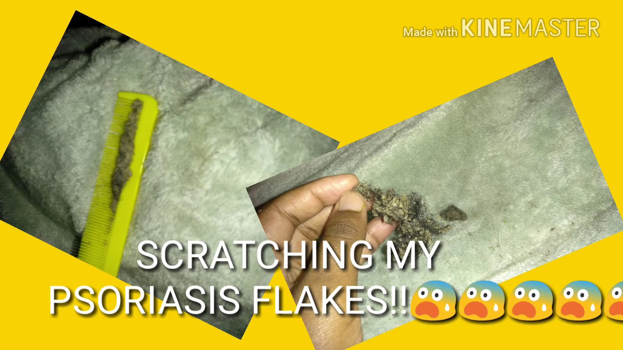 Satisfying scalp scratching// psoriasis flakes - YouTube