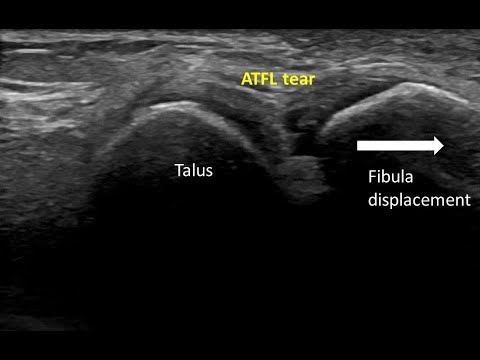 Ankle ATFL tear anterior drawer test in ultrasound dynamic exam (腳踝扭傷韌帶 ...