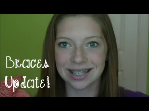 Braces Update! - YouTube