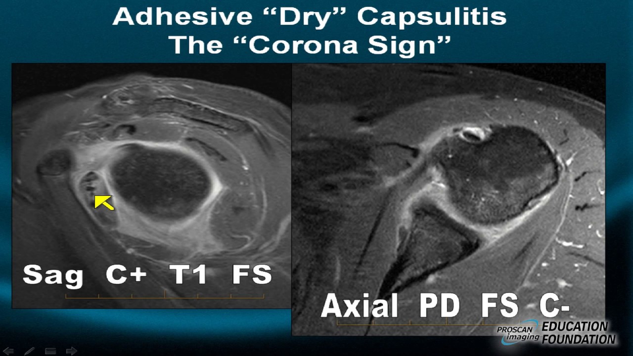 Shoulder Instability on MRI: Part III The golden rule of Dynamic Labral ...