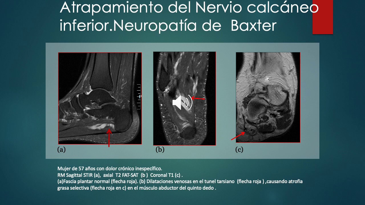 Caso del Mes n°10 Julio 2020, "Neuropatía Baxter Bilateral", Dr ...