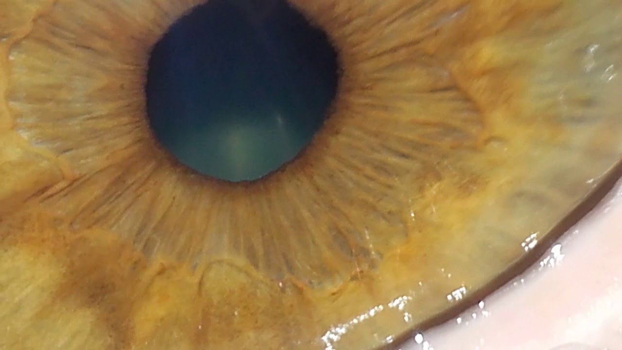 Nistagmus ( Dancing eyes). Nistagmo. - YouTube