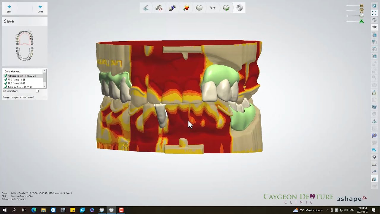 Cast Partial Upper and Lower Digital Designs - YouTube