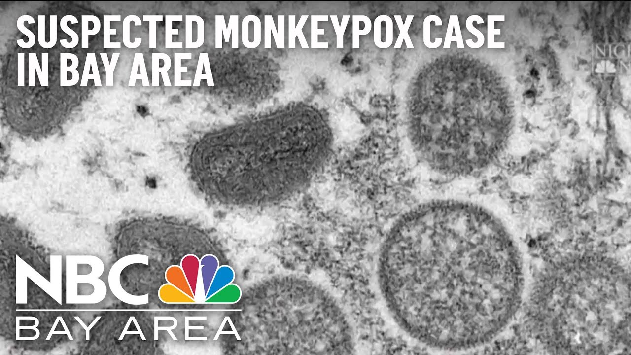 First ‘Probable' Monkeypox Case Detected in San Francisco: Officials ...