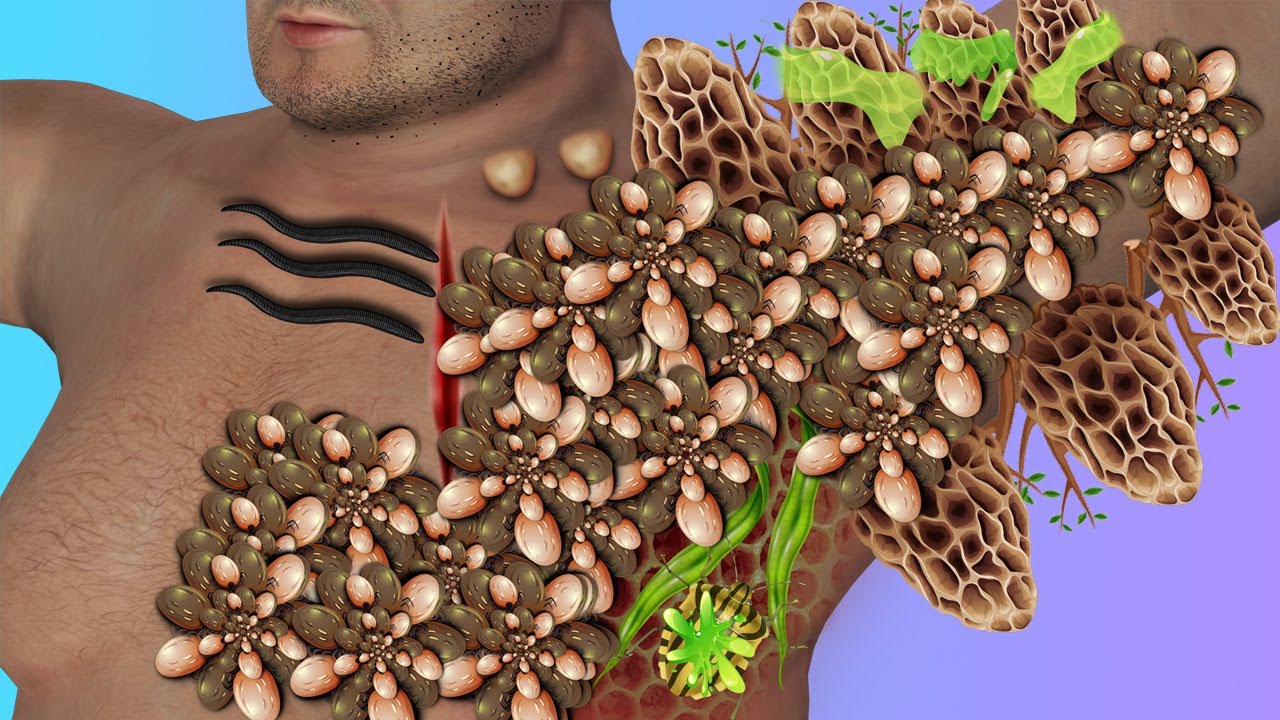 ASMR Remove Maggots & Worm Infected Arm | Severely Injured Animation ...